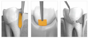 Amazing results with Periochip | Claregate | Wolverhampton